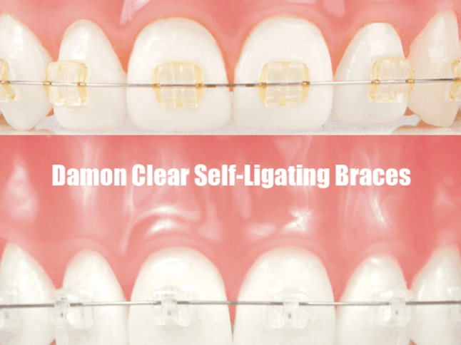 Conventional Braces vs. Self-Ligating Braces: An In-Depth Guide
